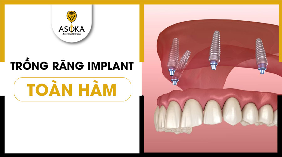 Trồng răng Implant Toàn Hàm All on 4 - All on 6