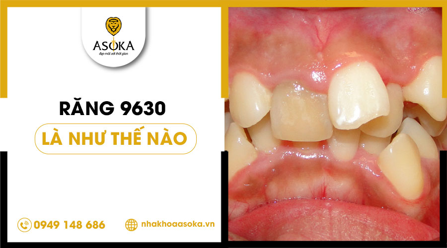 Hàm Răng 9630 là gì? Có làm sao không cách điều trị như thế nào