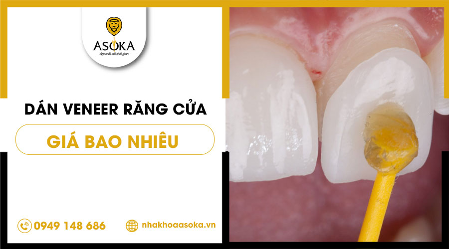 Dán sứ veneer 2 răng cửa giá bao nhiêu? Có bền không