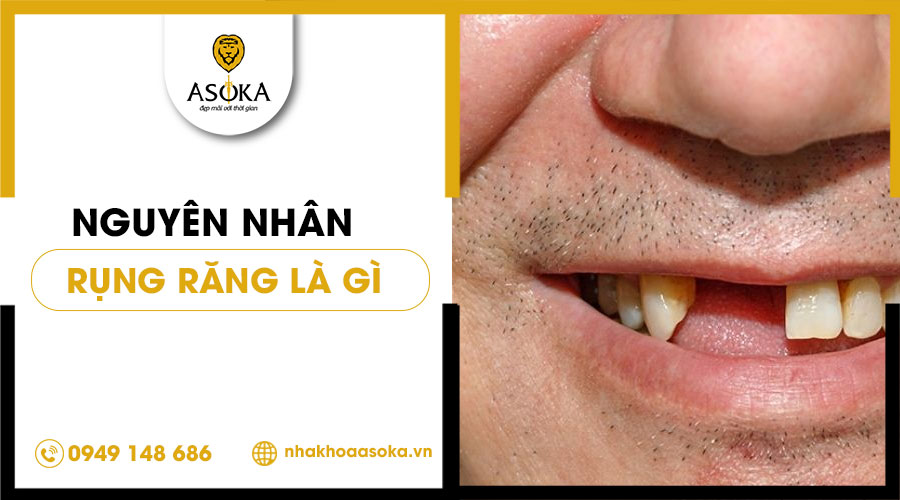 Nguyên nhân tự dưng bị rụng răng, gãy răng, mất răng là gì