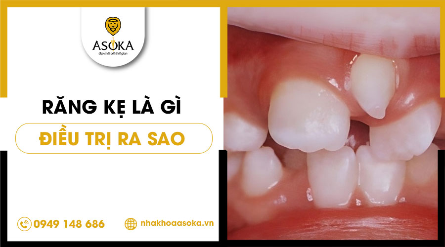 Răng kẹ là gì? Nhổ được không? Nguyên nhân và cách điều trị
