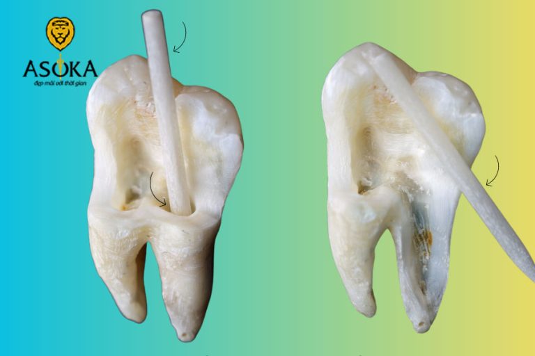 Cắm chốt răng có đau không? Giải đáp chi tiết từ A - Z