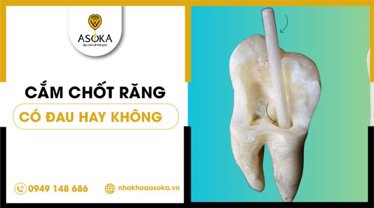 Cắm chốt răng có đau không? Giải đáp chi tiết từ A - Z